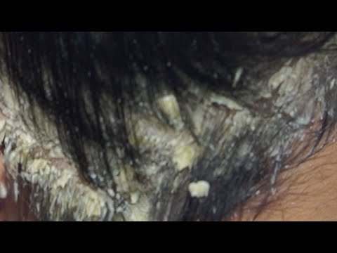Dandruff scratc3ing removal on head using black combing#2918