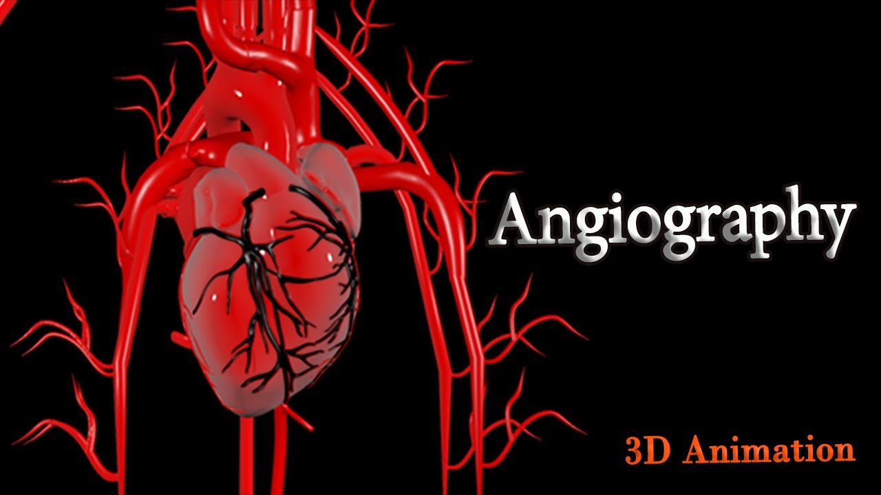 Angiography - Complete visual guide ( 3D Animation )