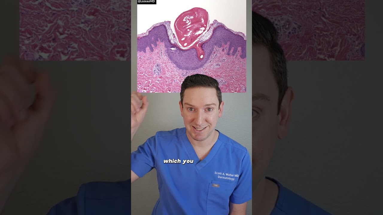Dermatologist explains KERATOSIS PILARIS: What Works? #keratosispilaris #chickenskin #bumpyskin