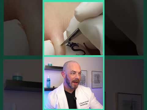 Doctor reacts to pus filled cyst pop! #dermreacts #doctorreacts #pimplepop