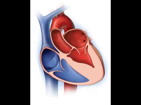 Sakamoto (Yamaguchi syndrome), or apical hypertrophic cardiomyopathy (ApHCM)