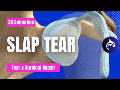 SLAP Tear and Repair - 3D Animation (No Narration)