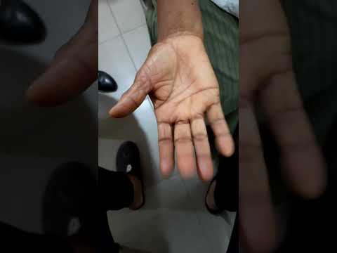 Trigger finger - Demonstrating the painful triggering of the fight middle finger