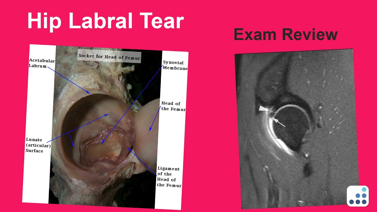 Hip Labral Tear Exam Review - John Clohisy, MD