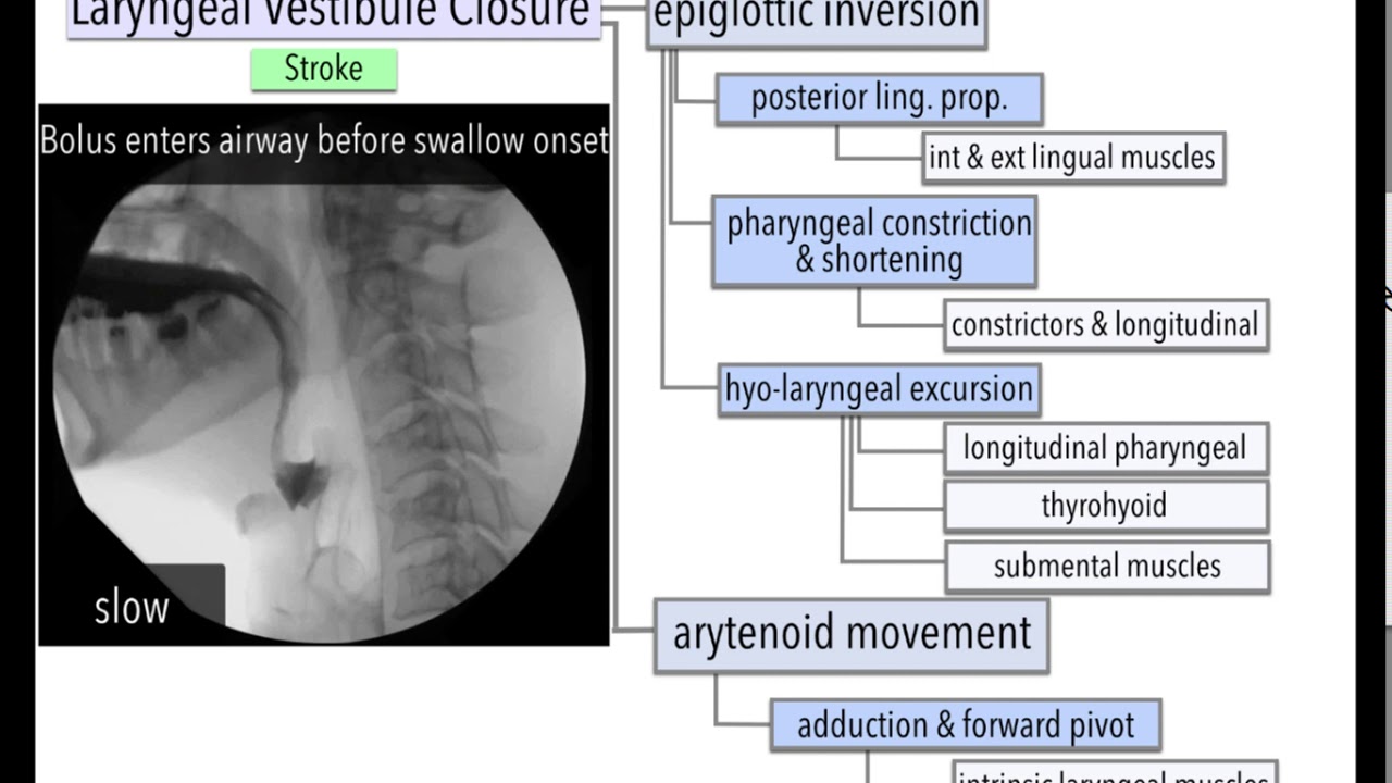 Epiglottic inversion strategies