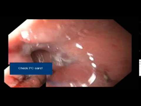Anastomotic Ulcer and Edema Following Gastric Bypass