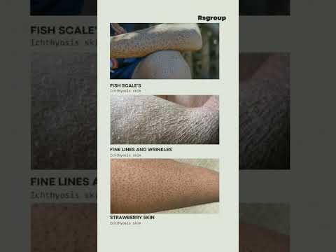 Ichthyosis Treatment: Effective Solutions for Skin Condition - Your Guide to Treating Ichthyosis