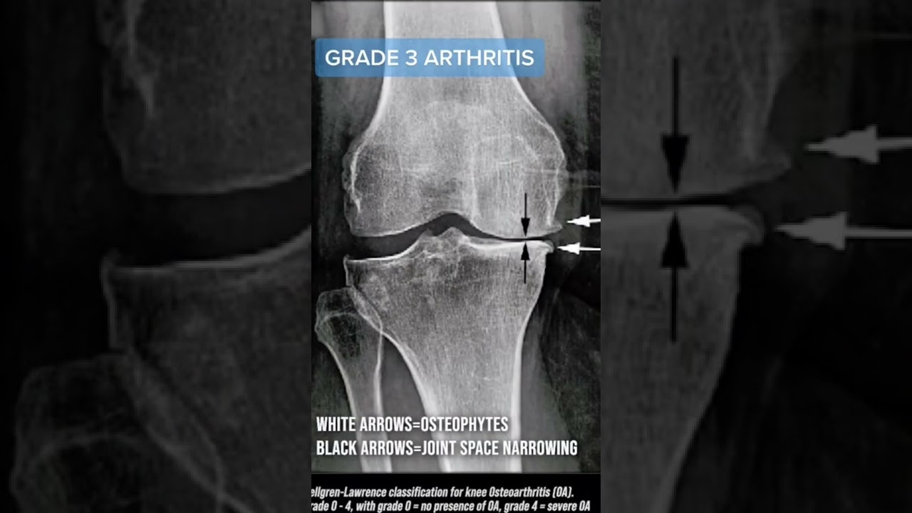 How Severe Is Your Knee Arthritis #shorts
