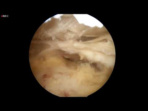 Arthroscopic Synovectomy and Removal of Loose Bodies in Synovial Osteochondromatosis of the Knee