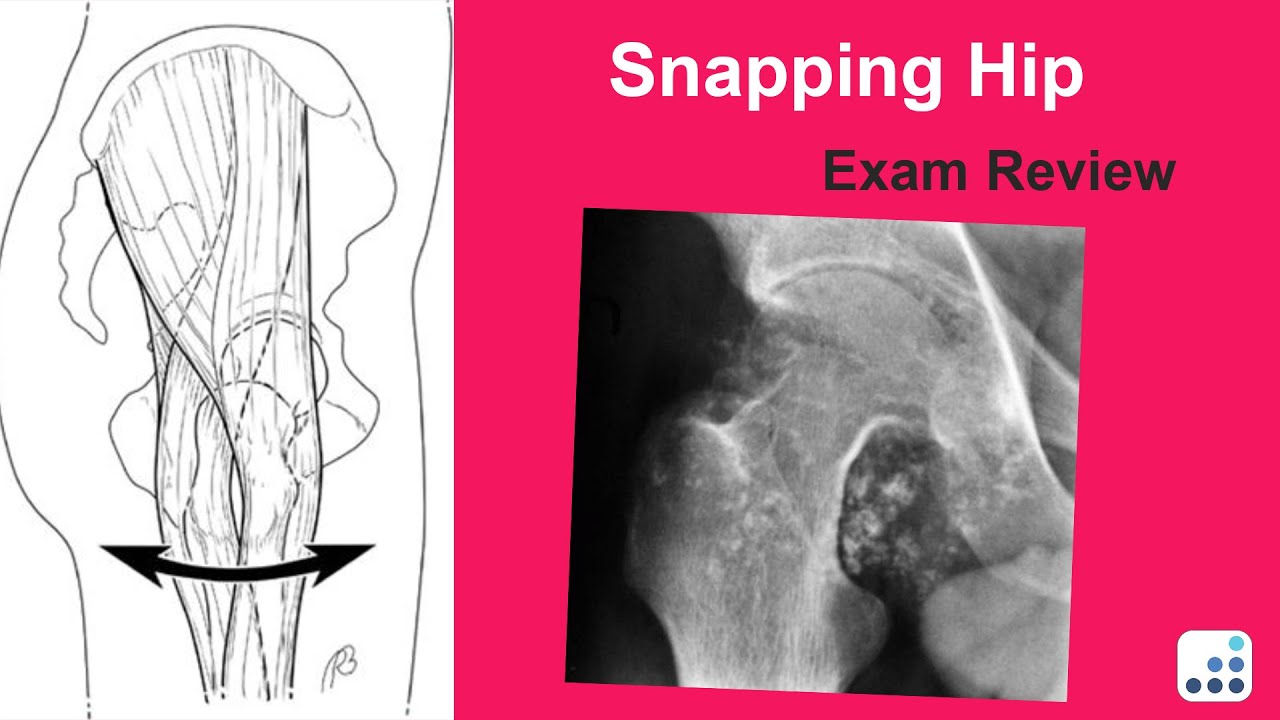 Snapping Hip Exam Review - John Clohisy, MD