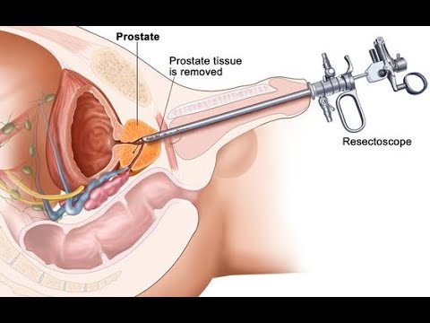 TURP explained and animation