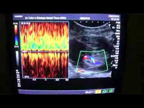 INDUCED ABORTION and its sequelae