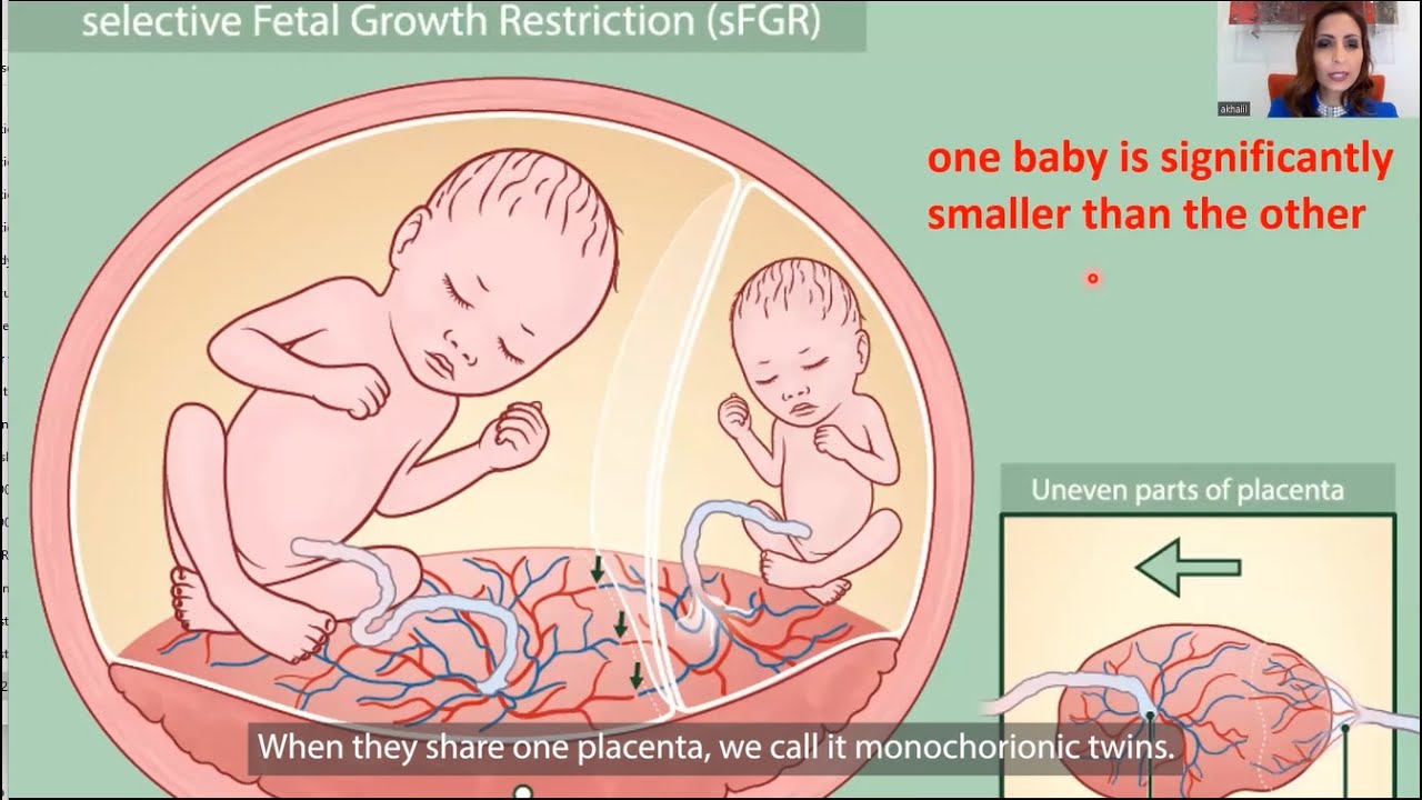 Growth Restriction