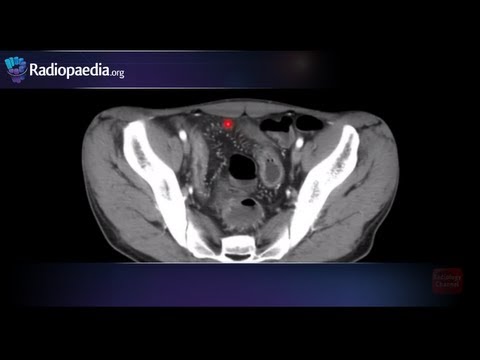 Comb sign – seen in active Crohn’s disease. It describes… | Radiopaedia