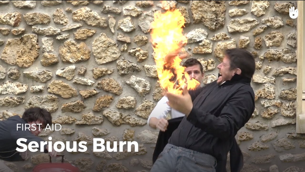 First Aid Serious Burn Learn How To Save A Life Sikana