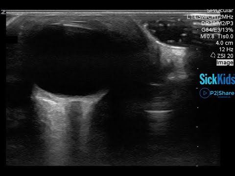 Diagnosing An Orbital Abscess Using Ocular POCUS