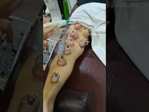 Cupping therapy for hamstrings. #asmr #duet #cuppingtherapy #sports