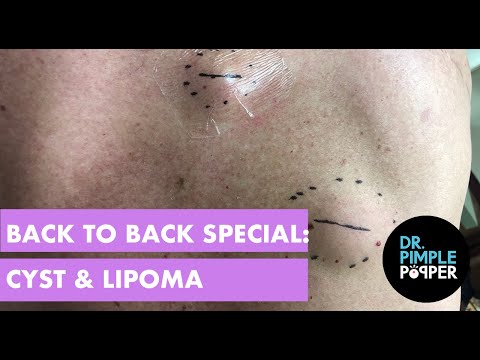 Dr. Pimple Popper Pops 'Ground Beef' Cyst And Lipoma In Video