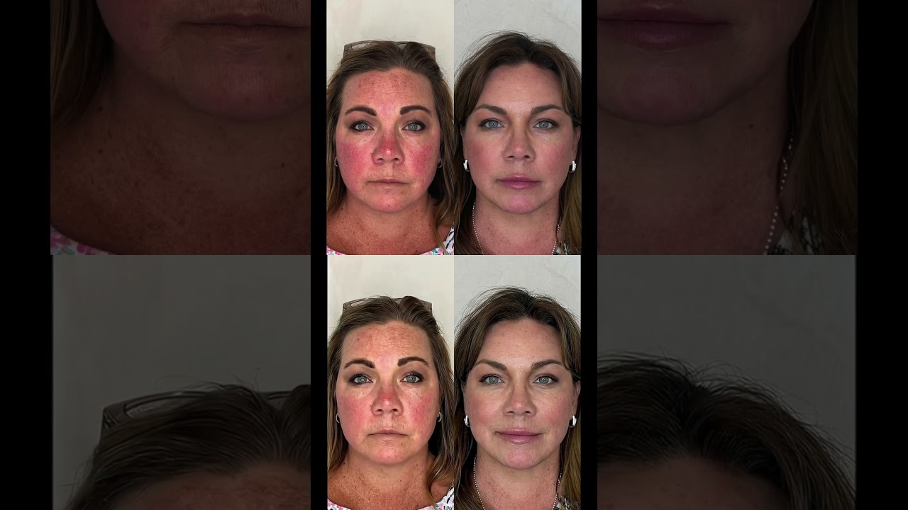 I turned this before and after photo into a video using AI. #before #after #beauty #ai #face #medspa