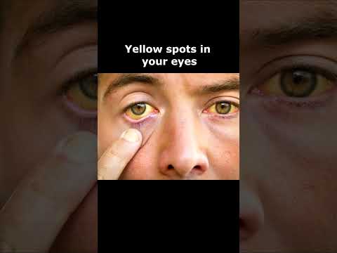 What Your Eye Symptoms May Mean  - Yellow