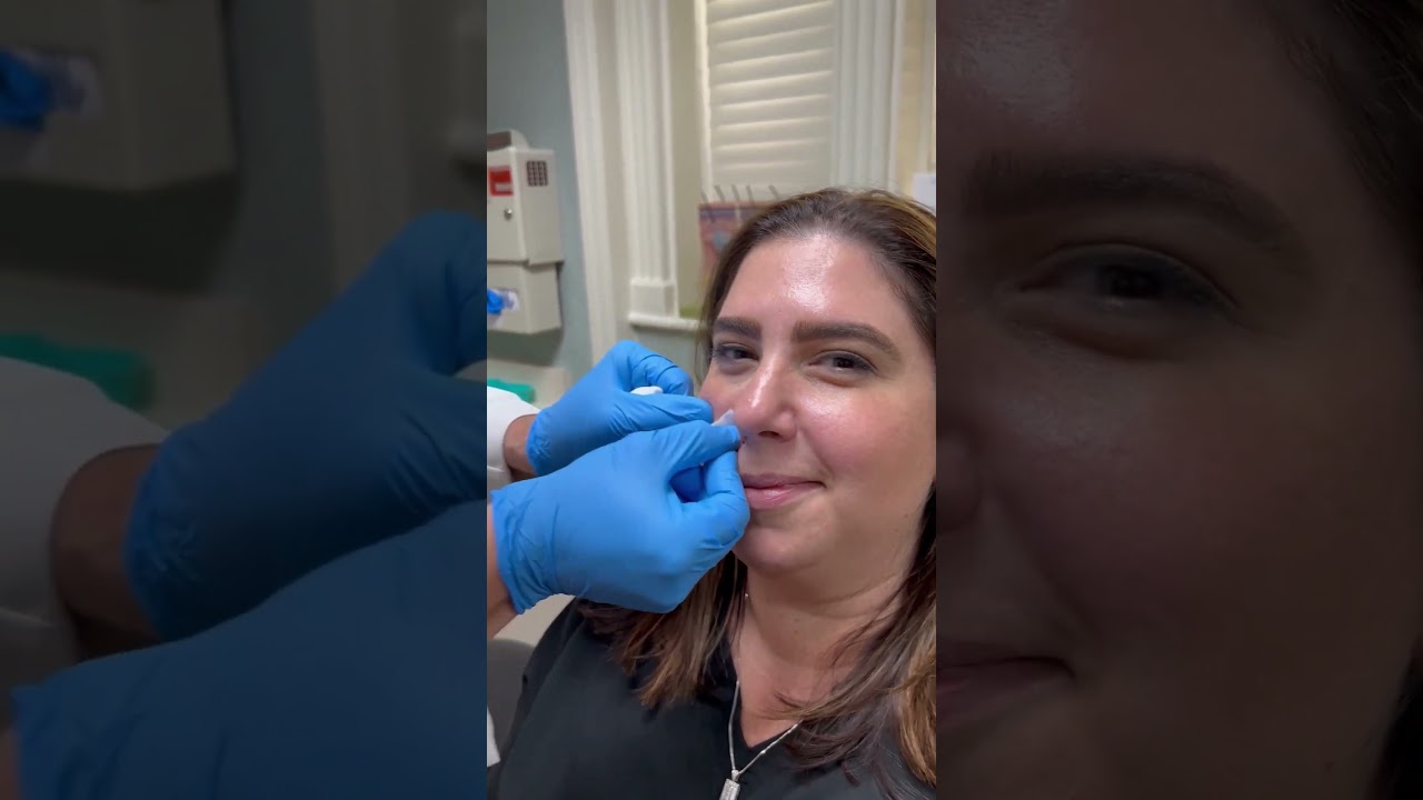 Show off that smile! #gummysmilebotox #lipflip #shorts