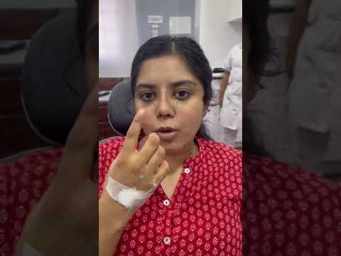 Rhinoplasty 7th day after Surgery- Patient feedback