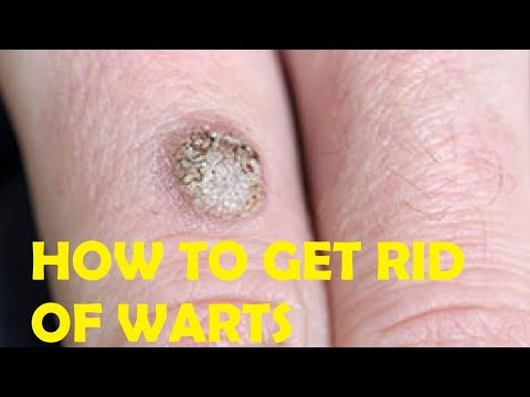 how to get rid of warts on your hand and fingers