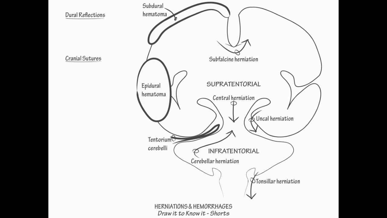 Herniation & Intracranial Hemorrhage - Draw it to Know it, Neuroanatomy