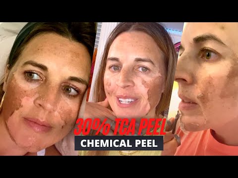 BEFORE AND AFTER 30% TCA Chemical Peel: Procedure, Peeling, Herpes