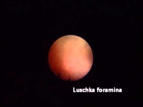 Neuroendoscopic Magendie and Luschka Foraminoplasty