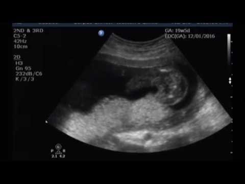 Amory Kim -  20wk Sonogram