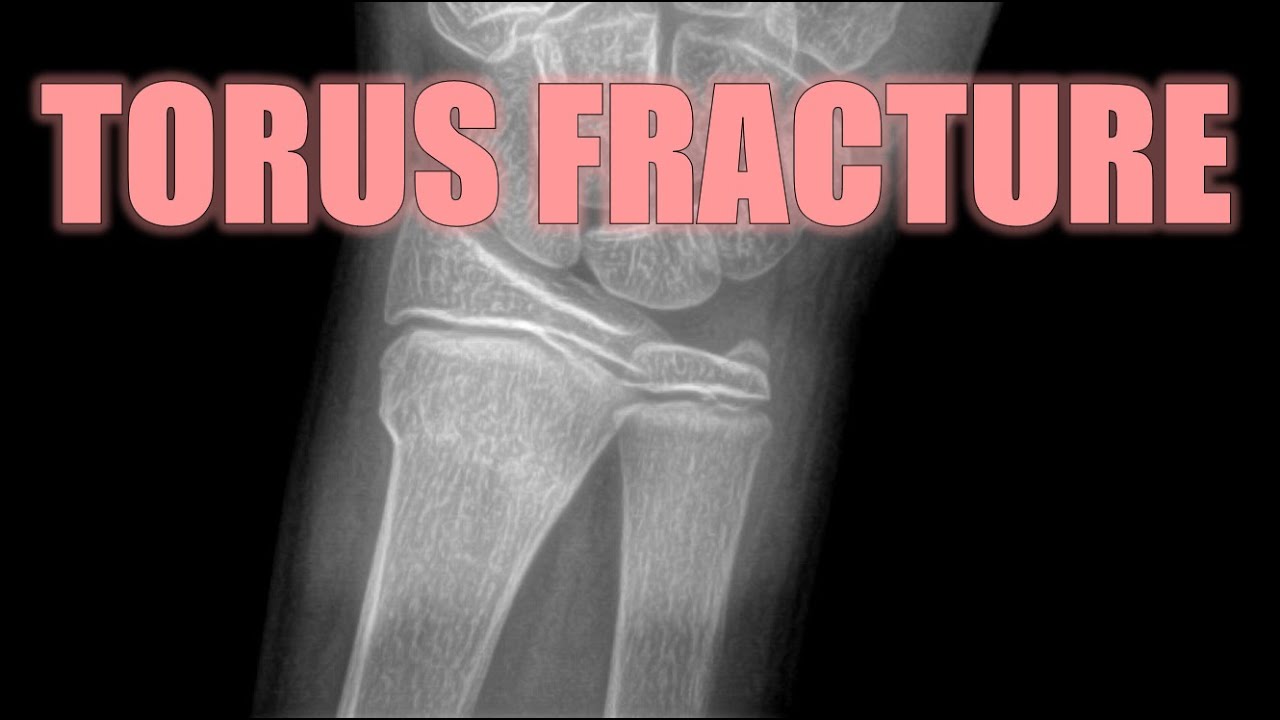 Torus Fracture