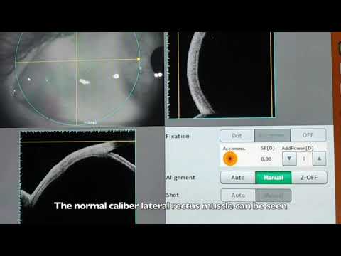 SS-ASOCT in strabismus re-operation - Supplementary video 2 [ID 328215]