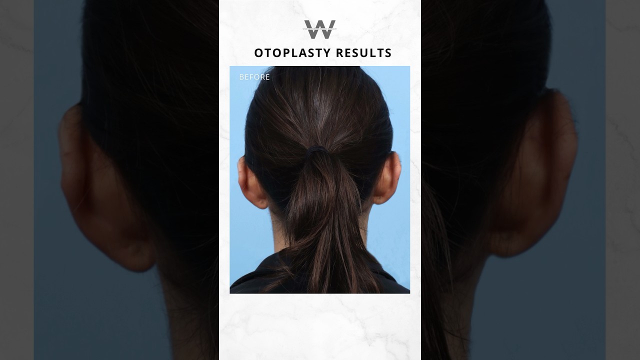 Before and after results: Otoplasty ear pinning procedure for prominent ears - by Dr. Jeffrey Wise