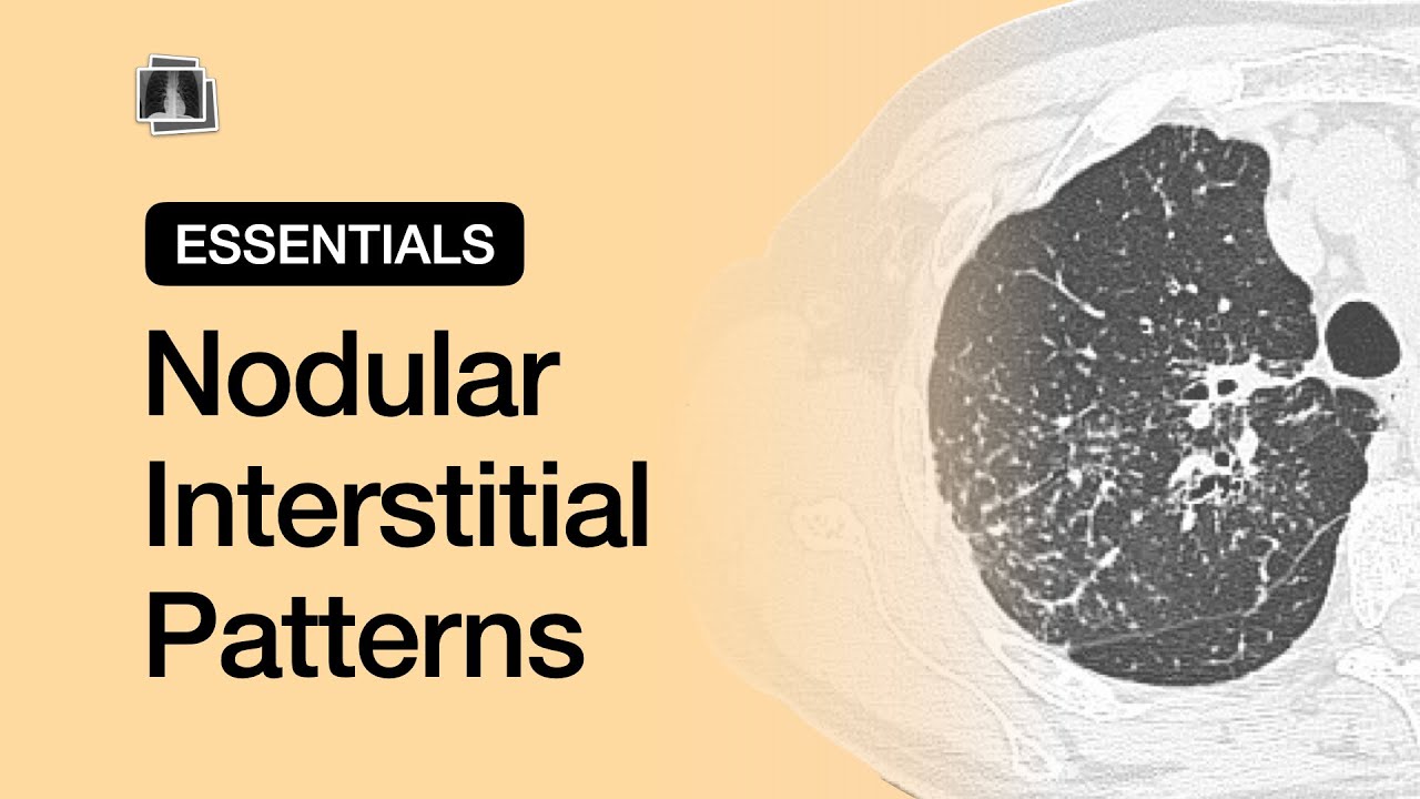 Nodular Interstitial Patterns | Chest Radiology Essentials