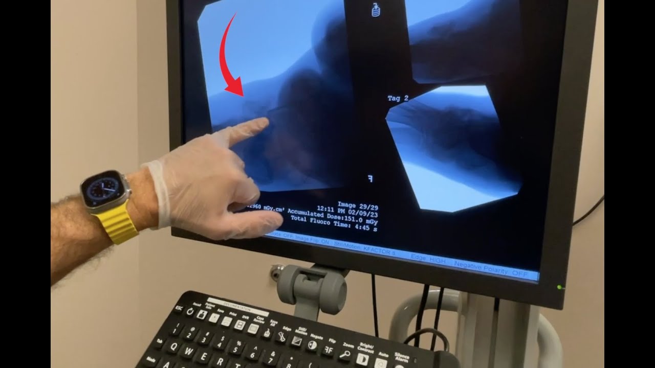 Stem Cell Treatment For a Fracture