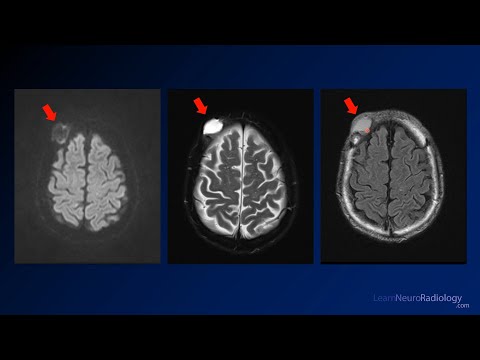 Neuroradiology board review 3 case 3