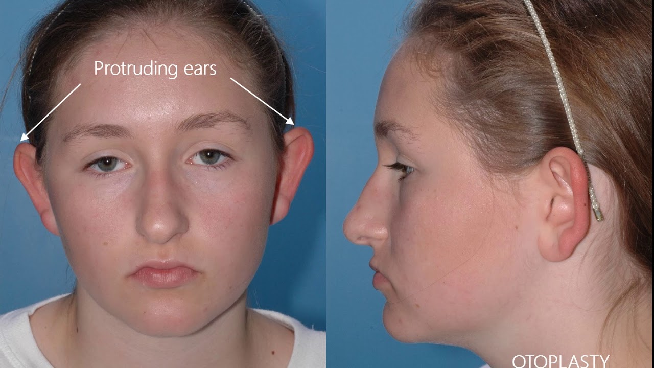 Otoplasty Case Study 1, from CW David Chang, MD and Columbia Facial Plastic Surgery