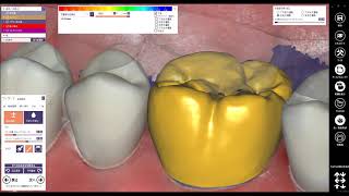 exocad | Ciデジタルソリューション