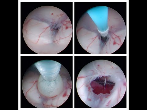 Endoscopic Third Ventriculostomy - ETV for Blake’s Pouch Cyst | Hydrocephalus and Syringomyelia