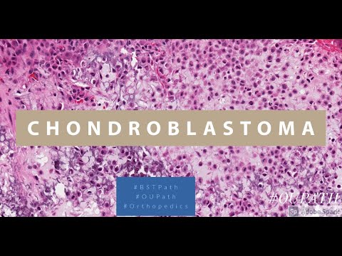 Chondroblastoma