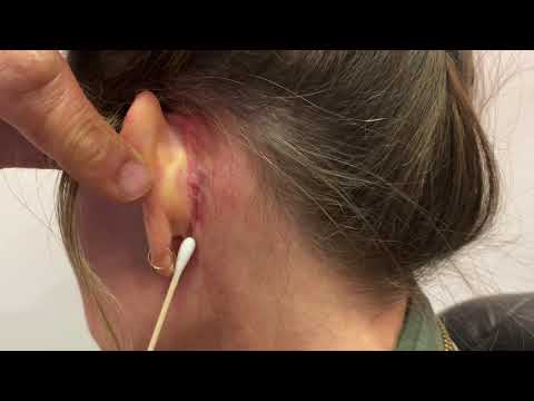FACELIFT SCARS