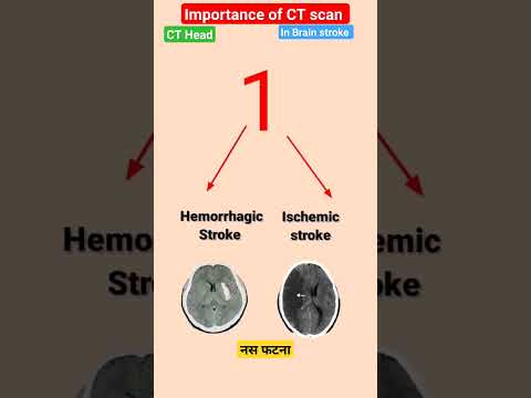 Importance of CT Scan in Brain stroke l CT Head #stroke #shorts
