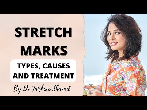 Stretch Marks | Types, Causes and Treatment for stretch marks | By Dr Jaishree Sharad