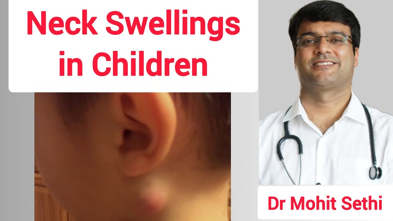 Neck Swelling in Children | Causes, Symptoms & Treatment of Neck Lump in Child