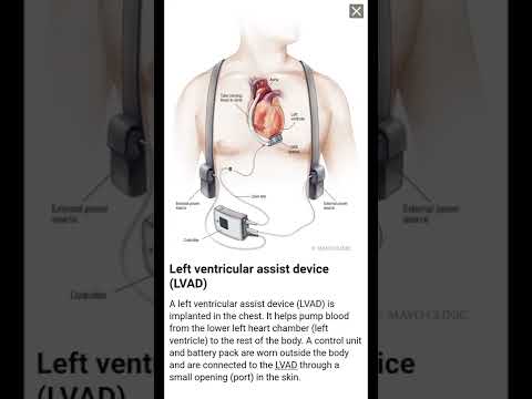 Heart surgery (Left ventricular assist device )