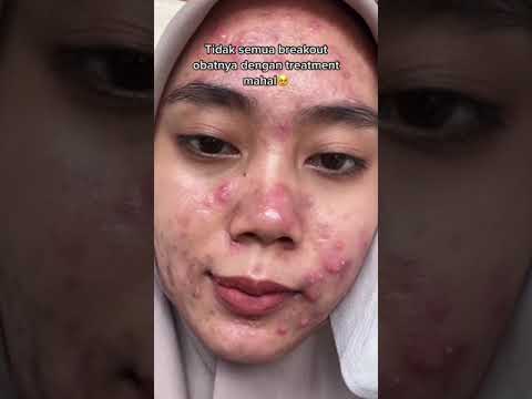 ✨Bisa jadi obatnya Moist viral ini????
