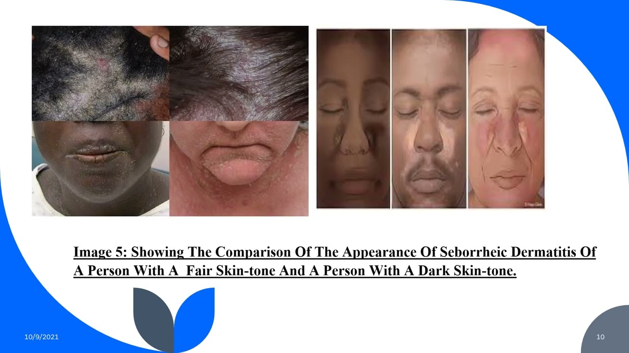 Pomerac - Seborrheic Dermatitis ppt