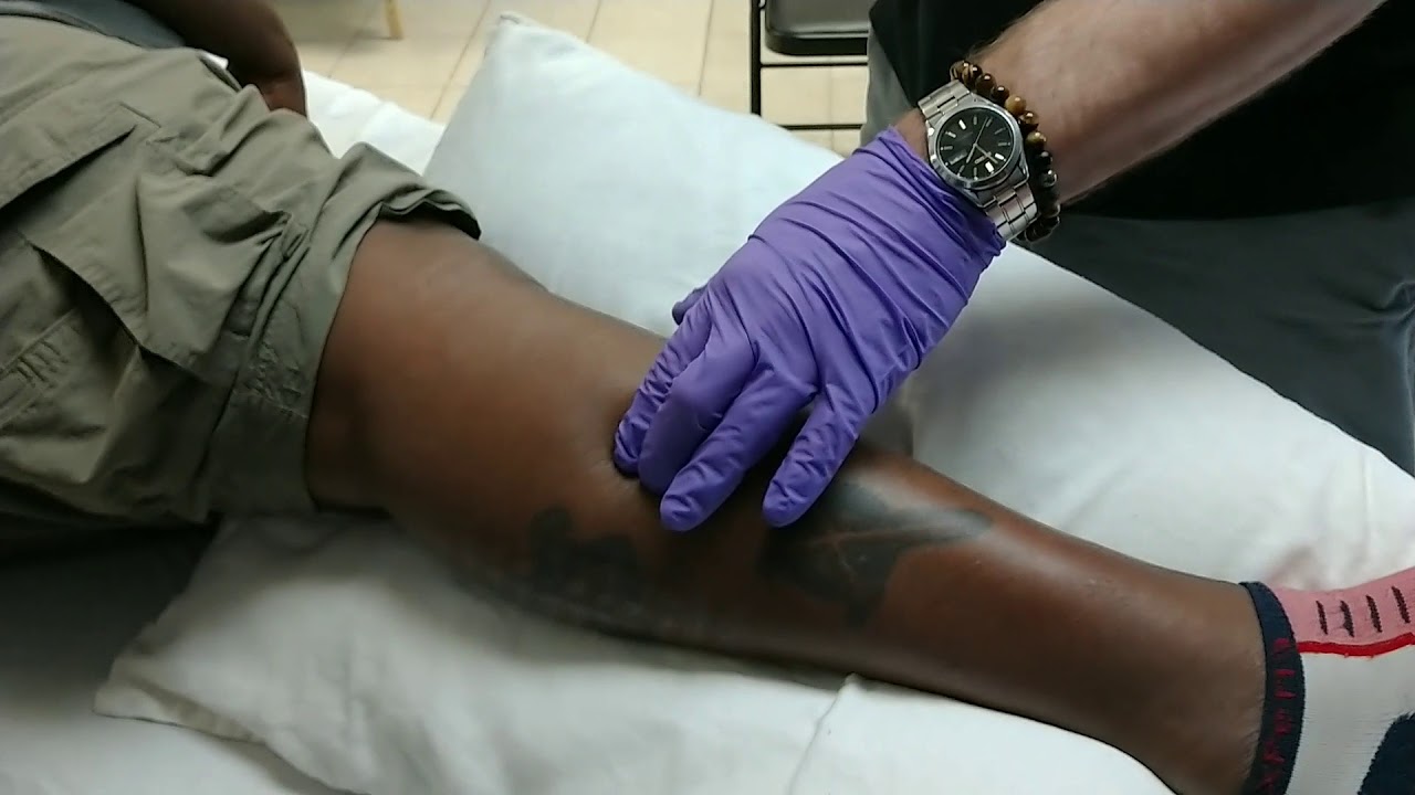 Orthopedic Trigger Point Acupuncture: Peroneals