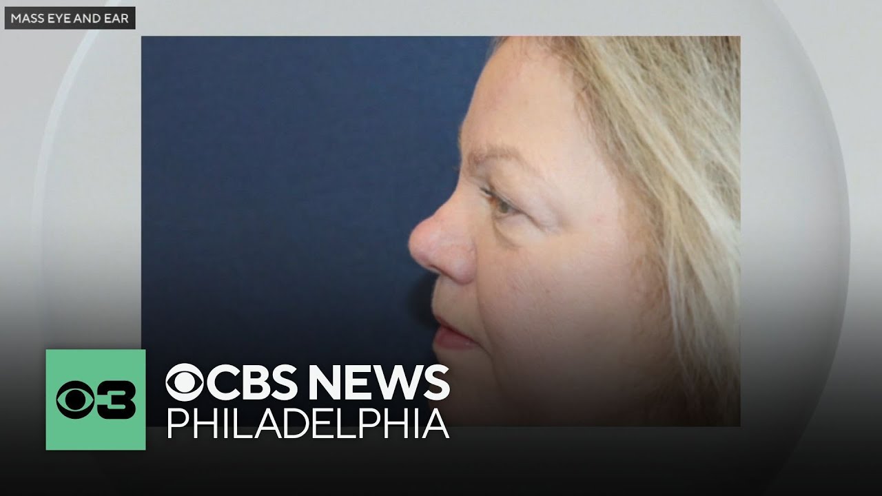 New procedure helps reconstruct nose after skin cancer